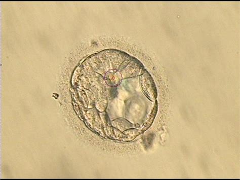 Day 5 Early Blastocyst Transfer How Does It Look Rembryologists
