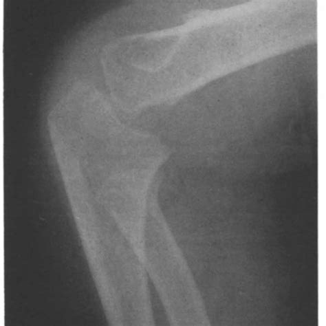 As Aged 4 Years Widening Of The Distal Ulnar Metaphysis With Spur