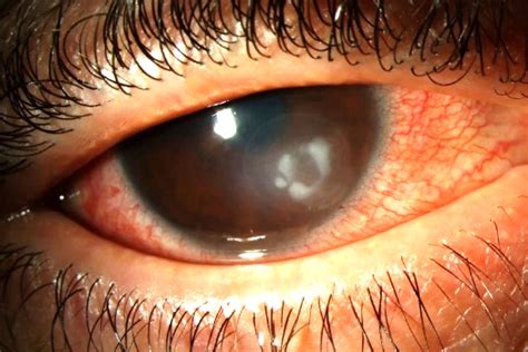 Case Report Of Corneal Ulceration Associated With Dupilumab Published In Clinical Insights In