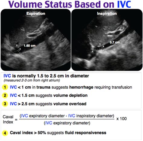 Focus For Ivc And Volume Status Flashcards Quizlet