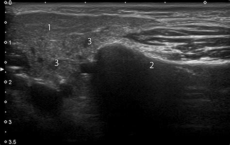 Crosssectional Imaging Of Parotid Gland Nodules A Brief Practical
