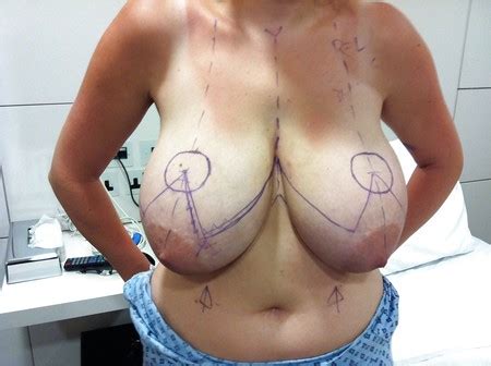 Pre Breast Reduction Tits Pics XHamster