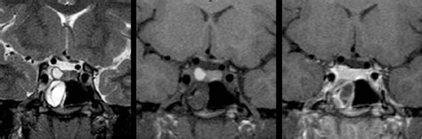 Figure 1 From Pituitary Apoplexy A Pictorial Review Semantic Scholar