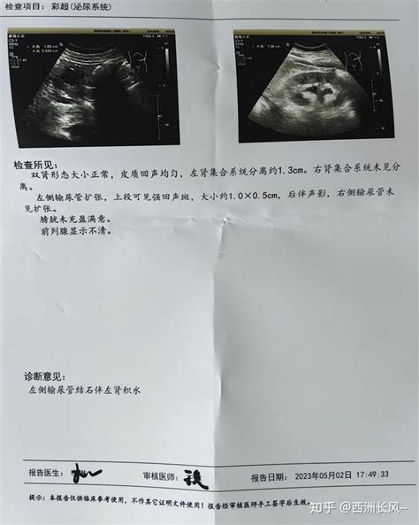 肾结石排石日记 知乎