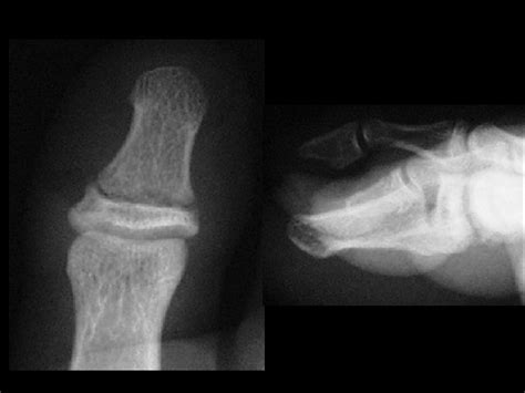 Anterior Shoulder Dislocation Findings Inferomedial Subcoracoid Displacement Of