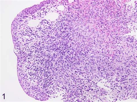 Postoperative Spindle Cell Nodule The Submucosal Nodule Consists Of Download Scientific