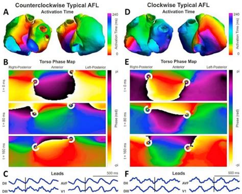 Cavotricuspid Isthmus Dependent Atrial Flutter Beyond Simple Linear Ablation Pmc