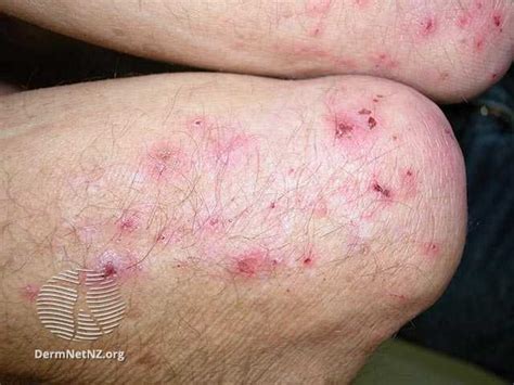 Celiac Rash Could Gluten Be The Cause Of Your Adverse Skin Conditions