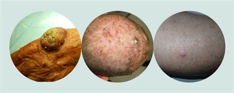 Squamous Cell Carcinoma Early Signs You Should Know