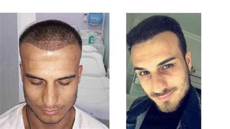Dhi Hair Transplant Before After Dhi Hair Transplantation Best