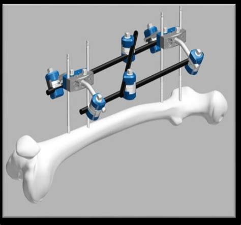 Modular External Fixator System By MadisonOrtho By Andrewrodrigues Issuu