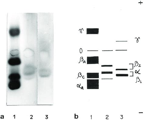 Globin Chains A Globin Chains Electrophoresis Performed In Download Scientific Diagram
