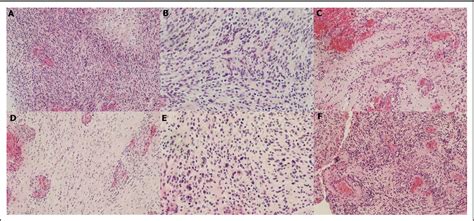 Figure 4 From Intramedullary Spinal Cord Primitive Neuroectodermal Tumor Presenting With