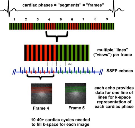 Cine Cardiac Mri Questions And Answers In Mri