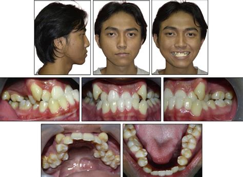 Class Iii Malocclusion Definition He Blogosphere Lightbox