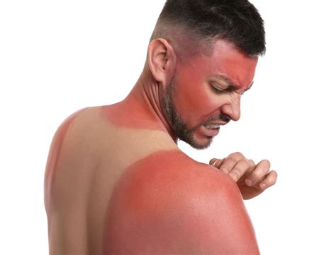 How To Stop Sunburn Itch Center One Medical