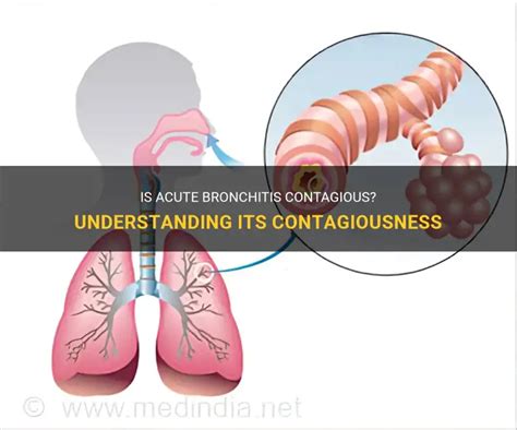 Is Acute Bronchitis Contagious Understanding Its Contagiousness Medshun