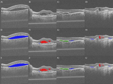 Deep Learning Based Multi Class Fluid Segmentation In Swept Source Oct Images Voxeleron