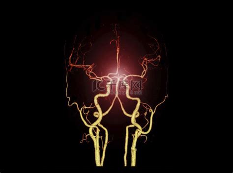 Cta 大脑或 Ct 脑血管造影 3d 渲染图像显示脑动脉。高清摄影大图 千库网