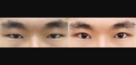 전후사진 3 페이지 앤드성형외과