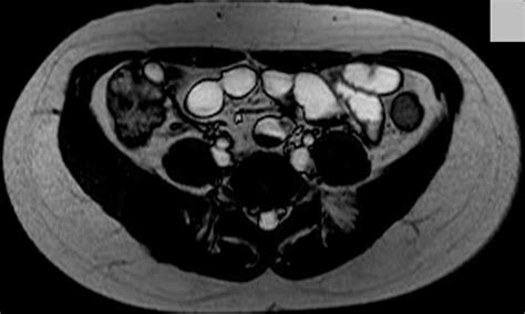 Plan Small Bowel Axial Trufi Mrimaster