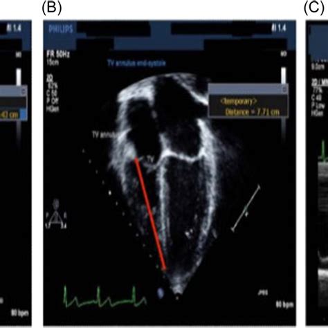 Tapse Is Determined By Using 2d Imaging A B Or Placing The M‐mode