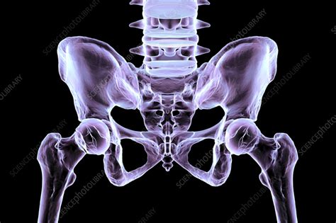 Subcapital Femur Fracture Illustration Stock Image F043 9258 Science Photo Library