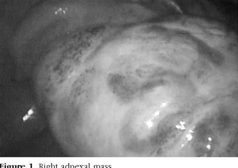 Figure 1 From Single Incision Laparoscopic Appendectomy And Dermoid Cyst Enucleation Semantic