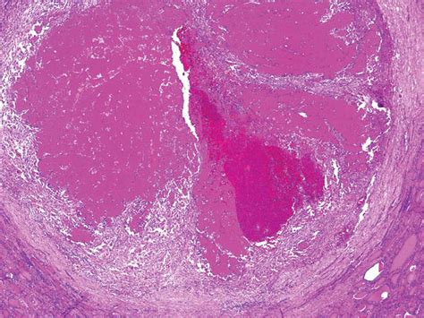 Thyroid Nodules In Diagnostic Pathology From Classic Concepts To