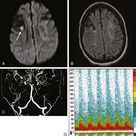 Uncommon Causes Of Stroke Radiology Key