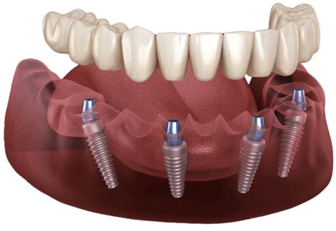 Permanent Teeth Solutions In Indiana Implant Clinic