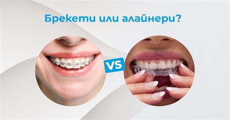 Брекети или алайнери Дентална клиника Identity гр Варна