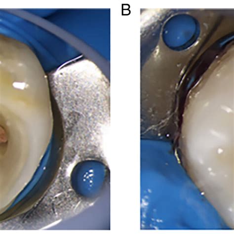 A Occlusal Surface Of Tooth 46 B Buccal Surface Of Tooth 46 The
