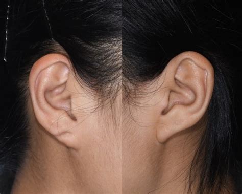 Gallery Ear Surgery Korea Cn