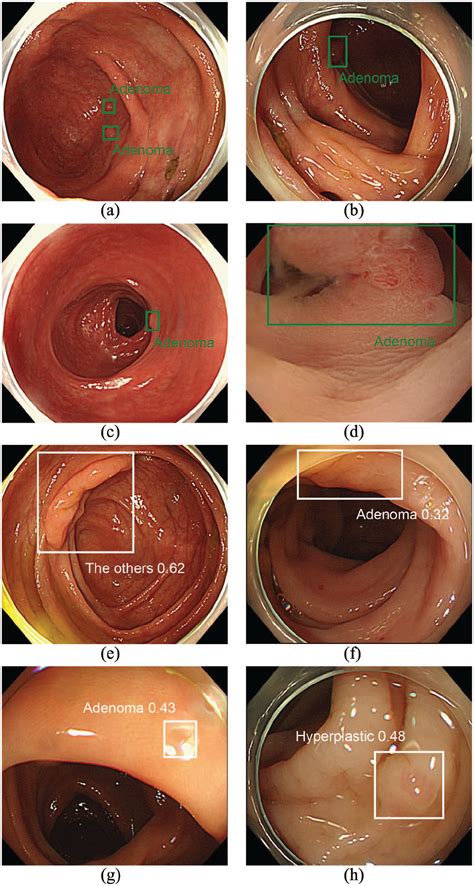 Automated Endoscopic Detection And Classification Of Colorectal Polyps Using Convolutional