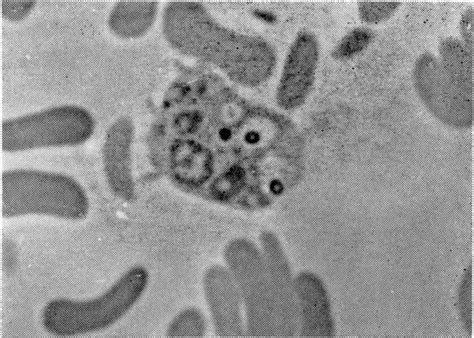 Polymorphonuclear Leukocyte With Ingested Bacteria Inside Phagocytic