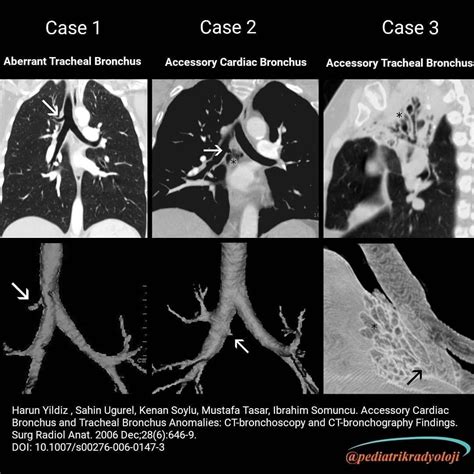 Bronchus Anomalies 👍 Case 1 World Of Radiology