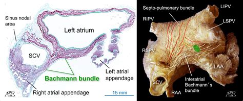 Iatrogenic Biatrial Flutter The Role Of The Bachmanns Bundle