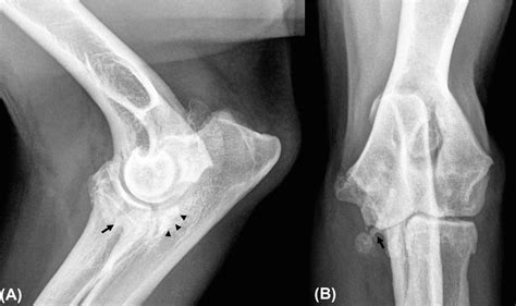 Coronoid Process Radiography