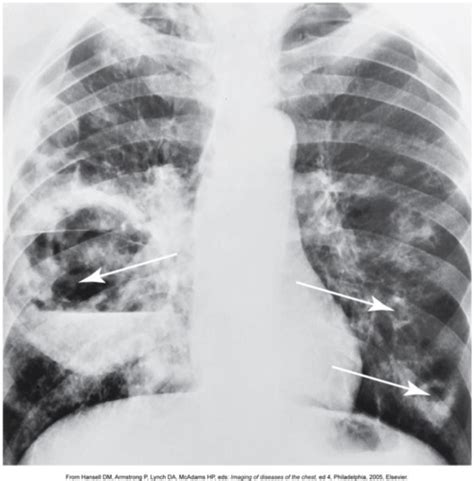 Lung Abscess Flashcards Quizlet
