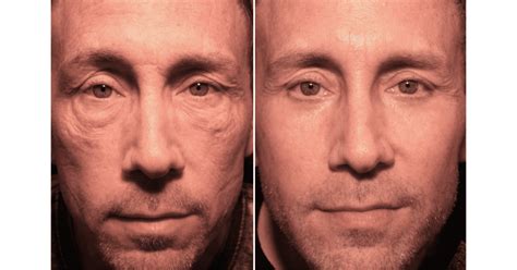 Innovating Eyelid And Facial Rejuvenation An Interview With Dr Adam