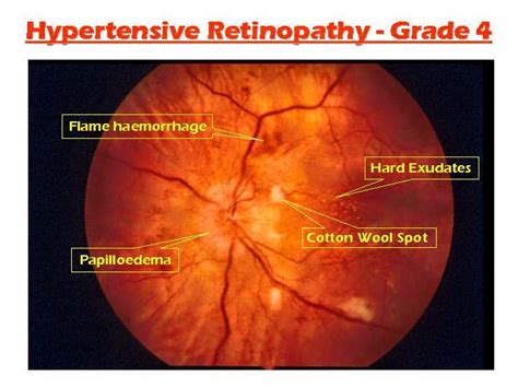 Emergency Medicine Diabetic And Hypertensive Retinopathy