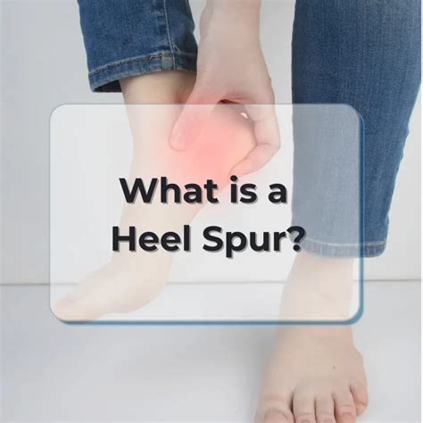 Heel Spurs What They Are Why They Happen And How To Treat Them