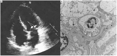 Systemic Bartonellosis Manifesting With Endocarditis And