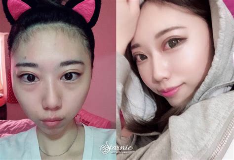 星和診所 台中 星和台中💗陳璟毅醫師 X 玻尿酸淚溝