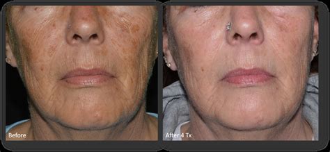 Lasemd Aftercare Instructions For Optimal Results Cynthia Golomb Md Dermatology Boutique