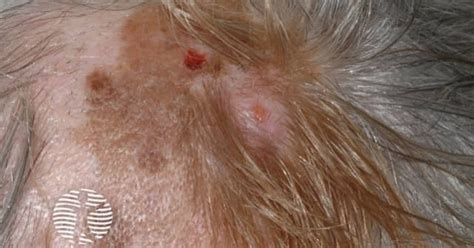Desmoplastic Melanoma Scalp Image