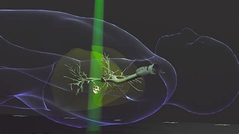 SBRT Noninferior To Conventional RT In Prostate Cancer