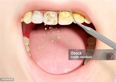 치과 도구를 사용한 전통적인 치주 요법에 의한 인간 치아의 치석 제거 치석에 대한 스톡 사진 및 기타 이미지 치석 사람들