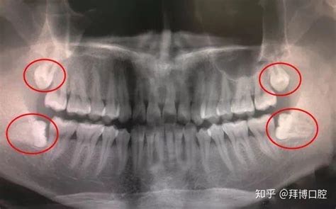 医生我的智齿不疼也不发炎该不该拔 知乎